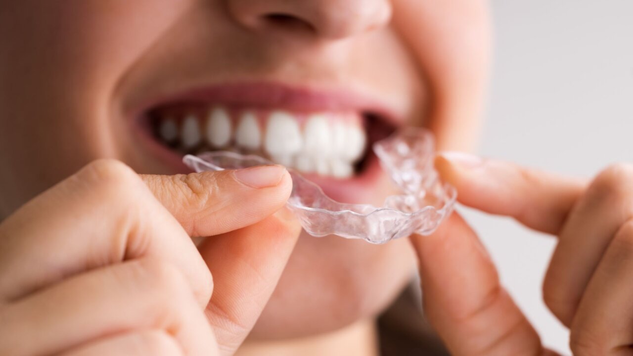 #1 Choice For Clear Aligners | Davis & Nyczepir Orthodontics